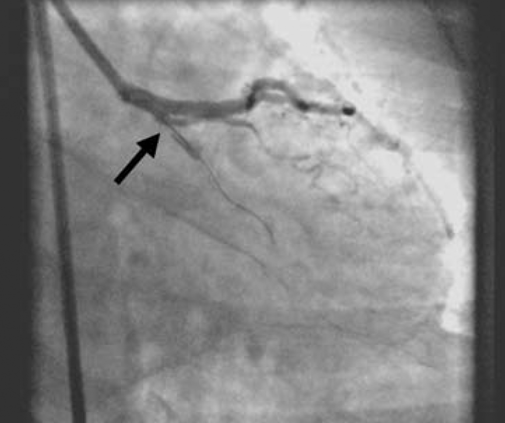 The Venture TM wire control catheter - The British Journal of Cardiology