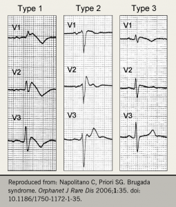Brugada syndrome in the context of a fever: a case study and review of ...
