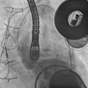Percutaneous transcatheter closure of the aortic valve to treat aortic ...