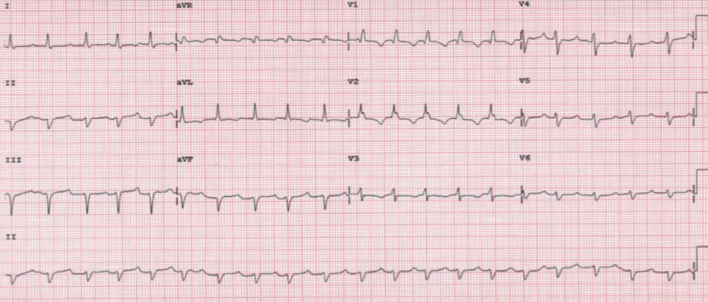 A transitory right bundle branch block - The British Journal of Cardiology