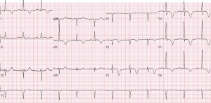 New-onset giant T-wave inversion with prolonged QT interval: shared by ...