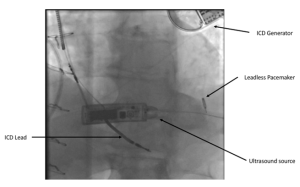 Pacing supplement: Leadless pacing - The British Journal of Cardiology