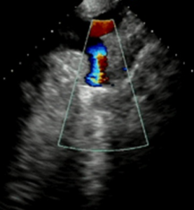 Percutaneous endovascular repair of congenital interruption of the ...