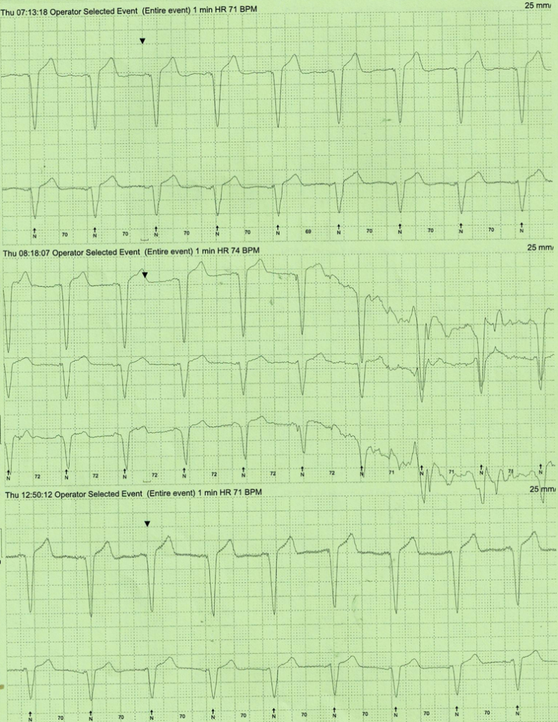 Significant suppression of premature ventricular ectopics with ...