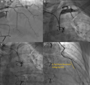 A simple technique for IMA graft angiography and PCI using ...