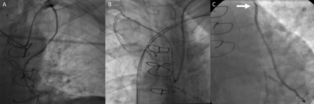 A simple technique for IMA graft angiography and PCI using ...