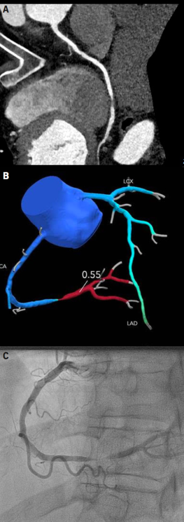 CT coronary angiography with HeartFlow ® : a user’s perspective - The ...