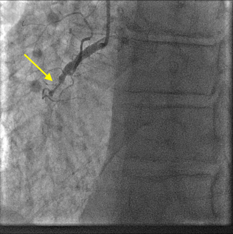 Atypical presentation of STEMI with pericardial effusion causing ...