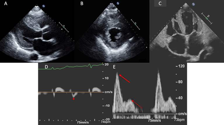 Amyloid heart disease module 1: diagnosis