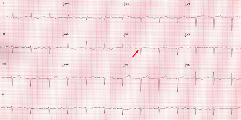 Amyloid heart disease module 1: diagnosis