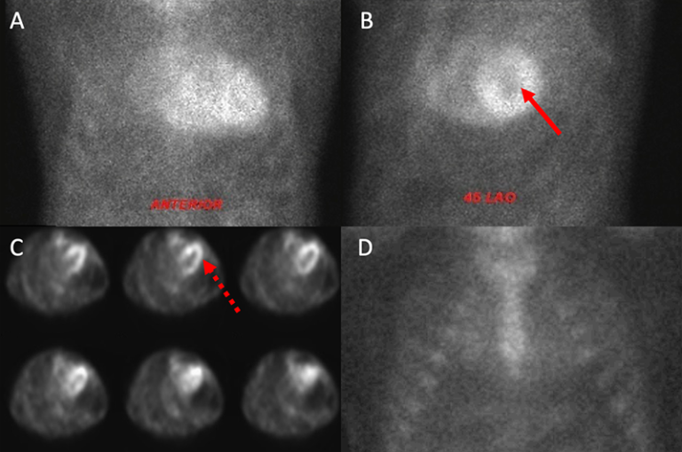 Amyloid heart disease module 1: diagnosis