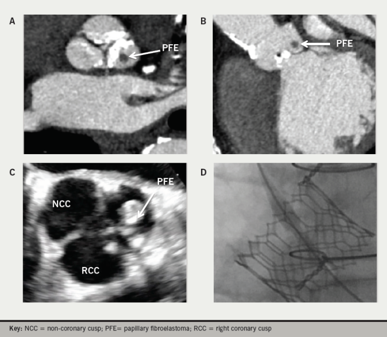 TAVR for severe aortic stenosis and papillary fibroelastoma in a high ...
