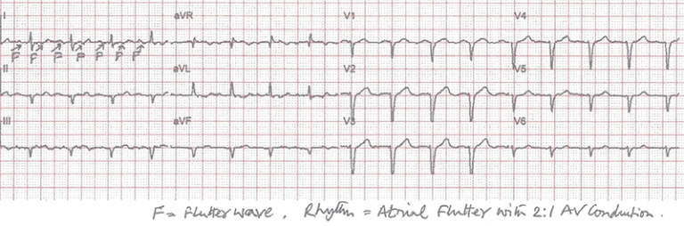 A broad complex tachycardia in a patient on flecainide