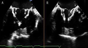 Transcatheter mitral valve intervention
