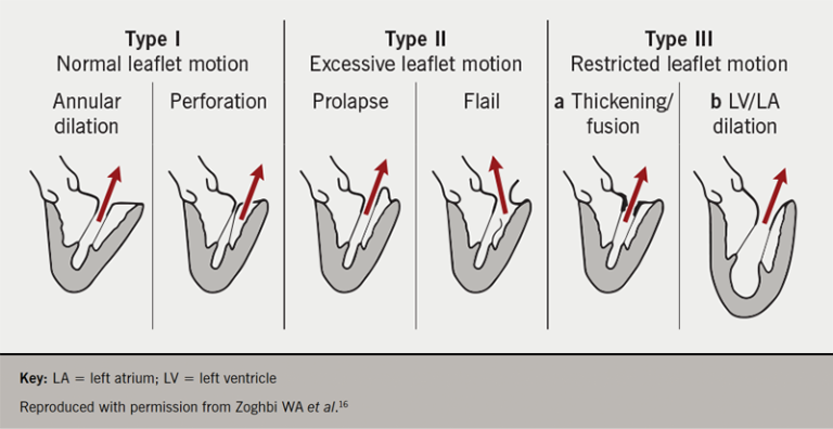 Transcatheter Mitral Valve Intervention Transcatheter Mitral Valve Intervention