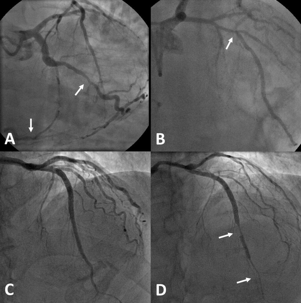 Angina with coronary microvascular dysfunction and its physiological ...