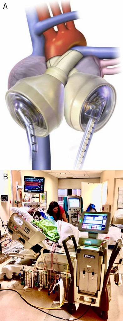 Evolution of a circulatory support system with full implantability ...