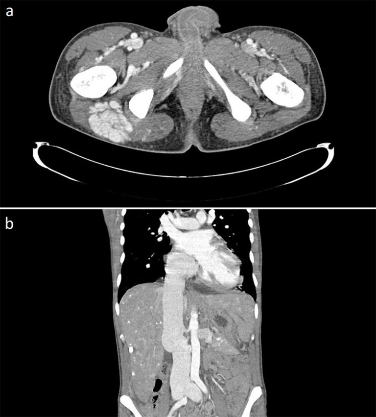 High-output heart failure due to arteriovenous malformation treated by ...