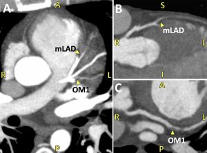 Age and the power of zero CAC in cardiac risk assessment: overview of ...