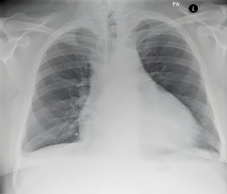 COVID-19 related myopericarditis and cardiac tamponade: a diagnostic ...