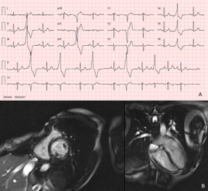 Pectus excavatum with right ventricular compression-induced ventricular ...