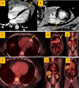 Cardiac sarcoidosis: the role of cardiac MRI and 18F-FDG-PET/CT in the diagnosis and treatment ...