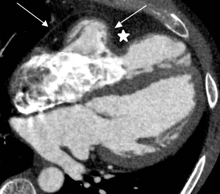 Congenital absence of the right pericardium: managing patients long ...
