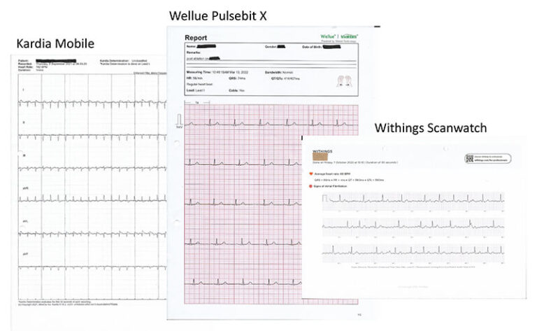Personal recording devices for arrhythmia detection