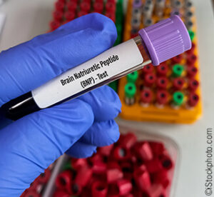 Assessment of the diagnostic value of NT-proBNP in heart failure with ...