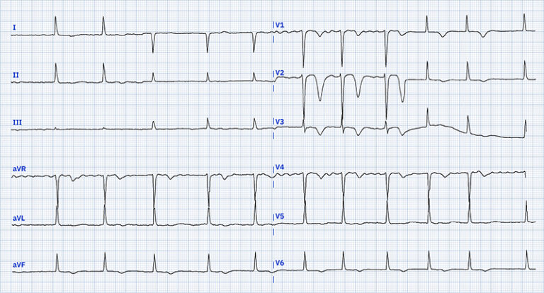 Successful medical management of Wellens’ syndrome type B in an elderly ...