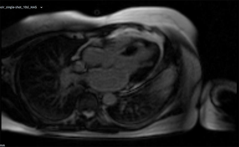 Heartbeats interrupted – unveiling cardiac sarcoidosis