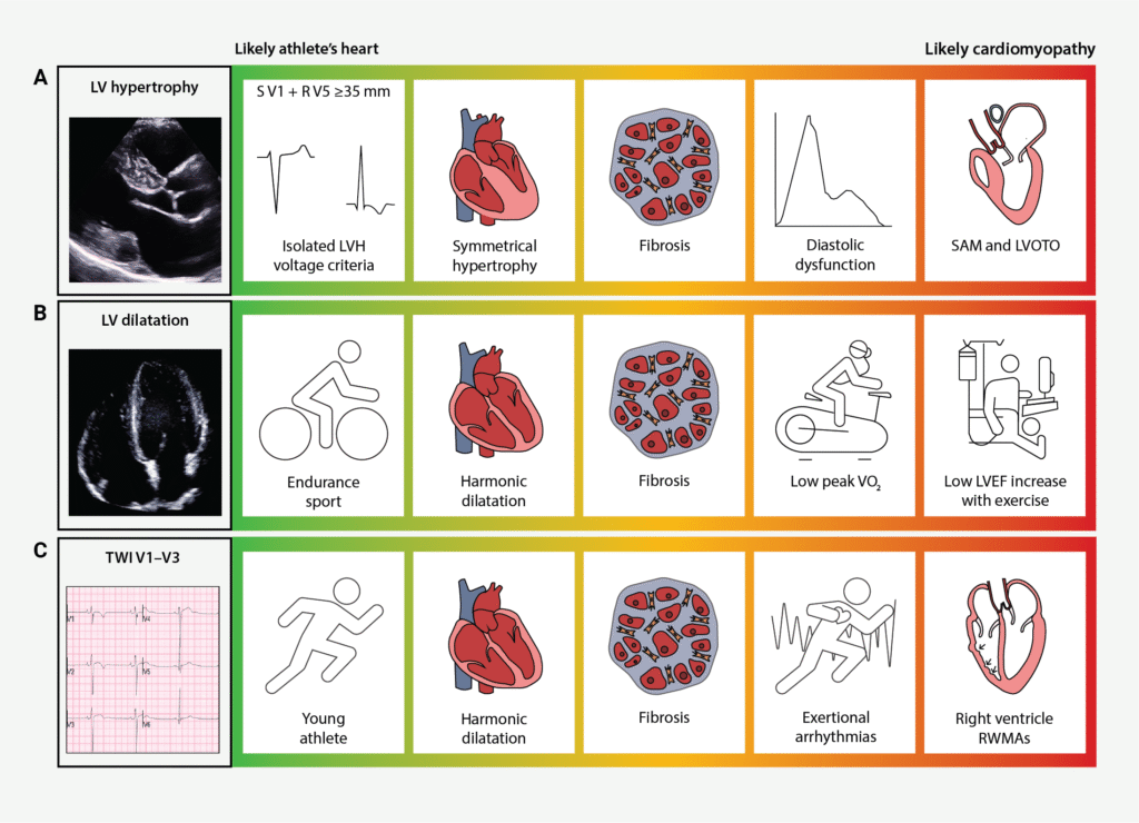 Differential diagnosis between ‘athlete’s heart’ and cardiomyopathies