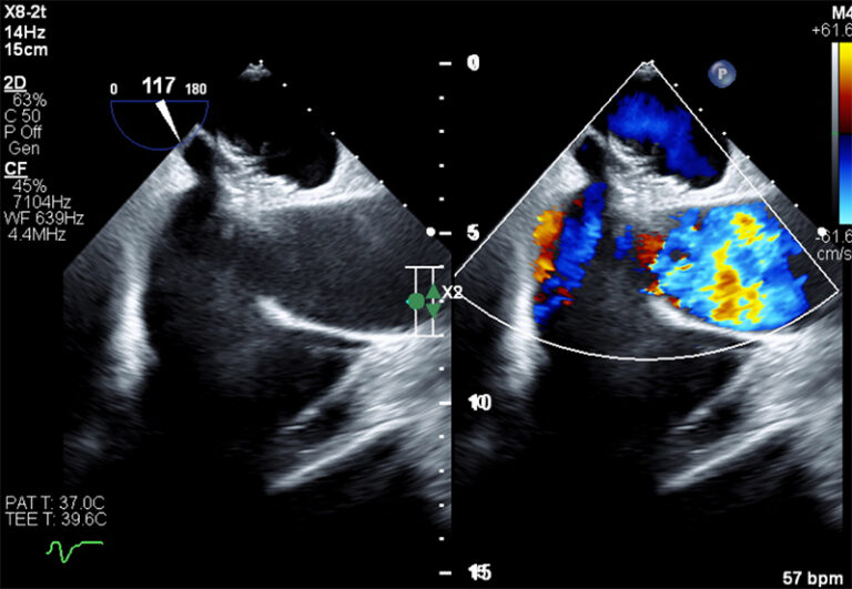 Platypnea-orthodeoxia syndrome – a rare presentation and diagnostic ...