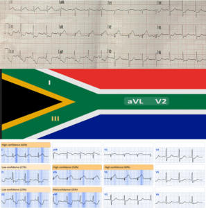 The convergence of diversity: an ECG sign of high lateral coronary ...