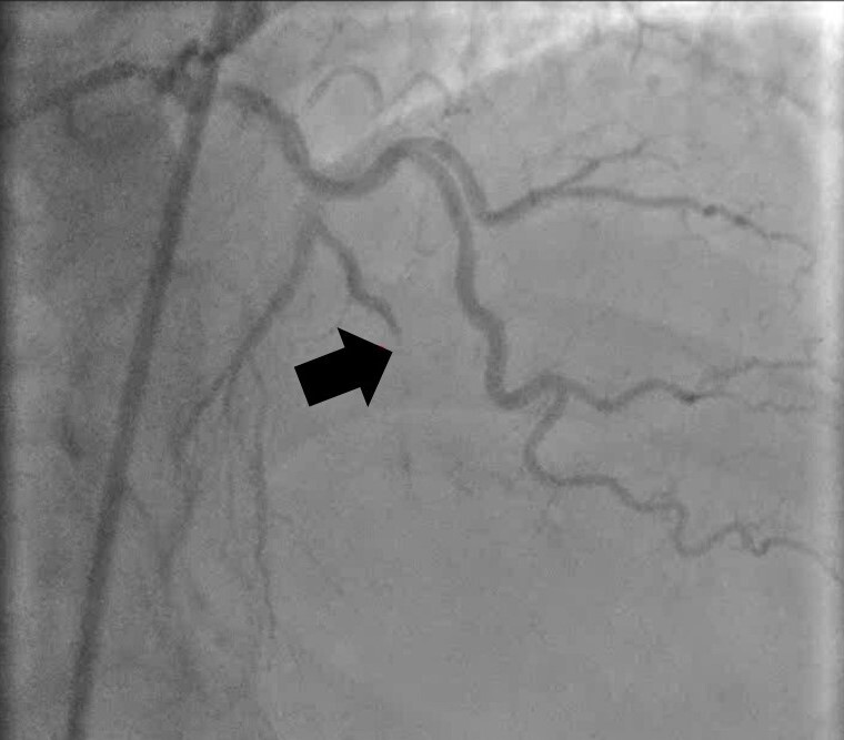 Balloon-uncrossable SVG lesion managed with recanalisation of CTO using ...