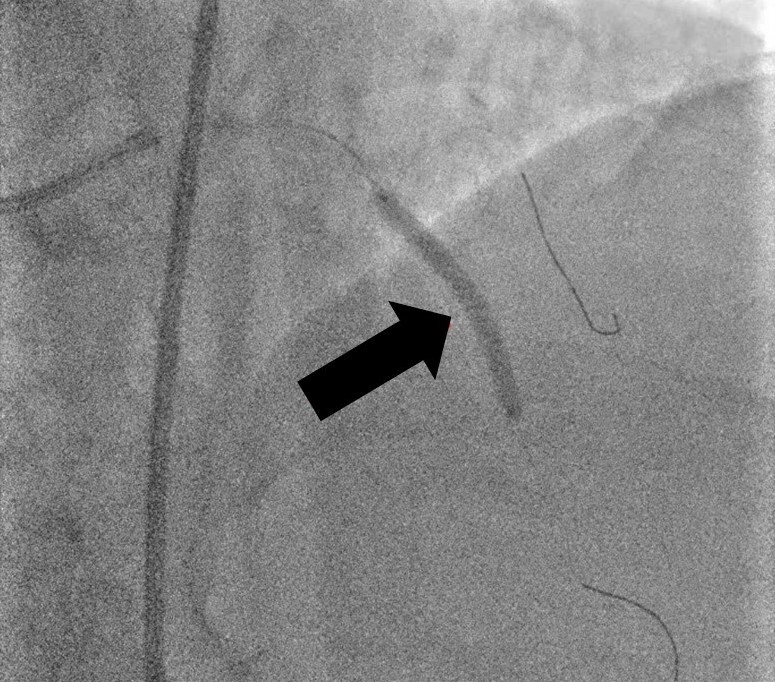 Balloon-uncrossable SVG lesion managed with recanalisation of CTO using ...