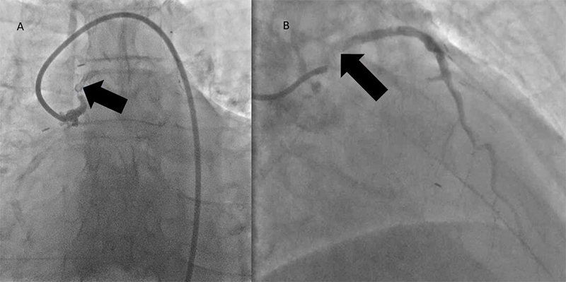 Balloon-uncrossable SVG lesion managed with recanalisation of CTO using ...