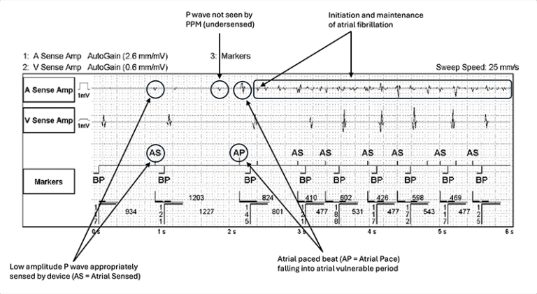 Optimising the management of temporary epicardial atrial pacing to ...