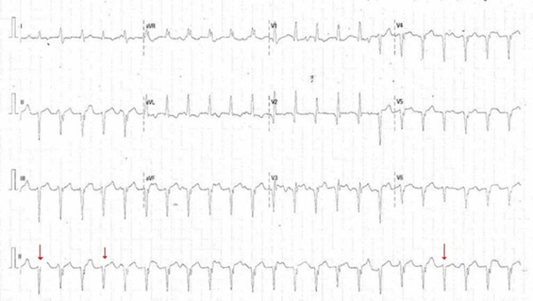 Refractory ventricular tachycardia: clinical challenges and management ...