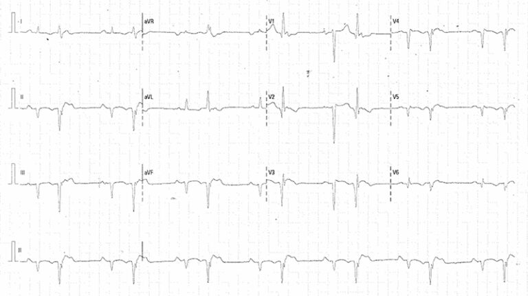 Refractory ventricular tachycardia: clinical challenges and management ...
